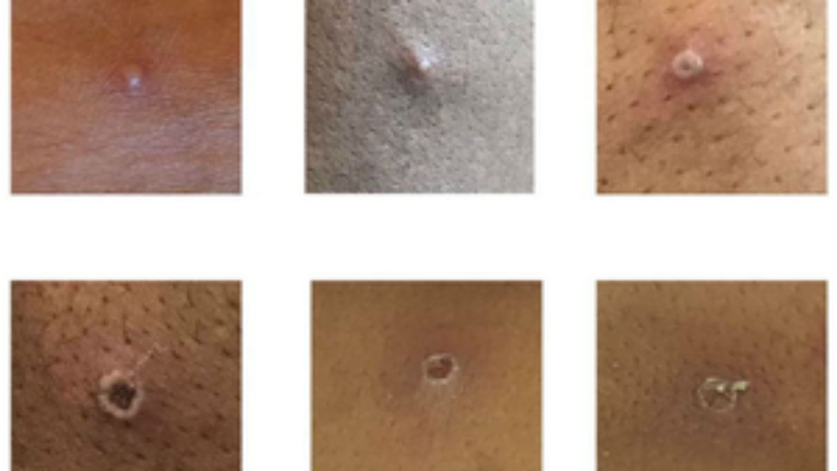 Wie gefährlich sind die Affenpocken? Alle wichtigen Fragen und ...